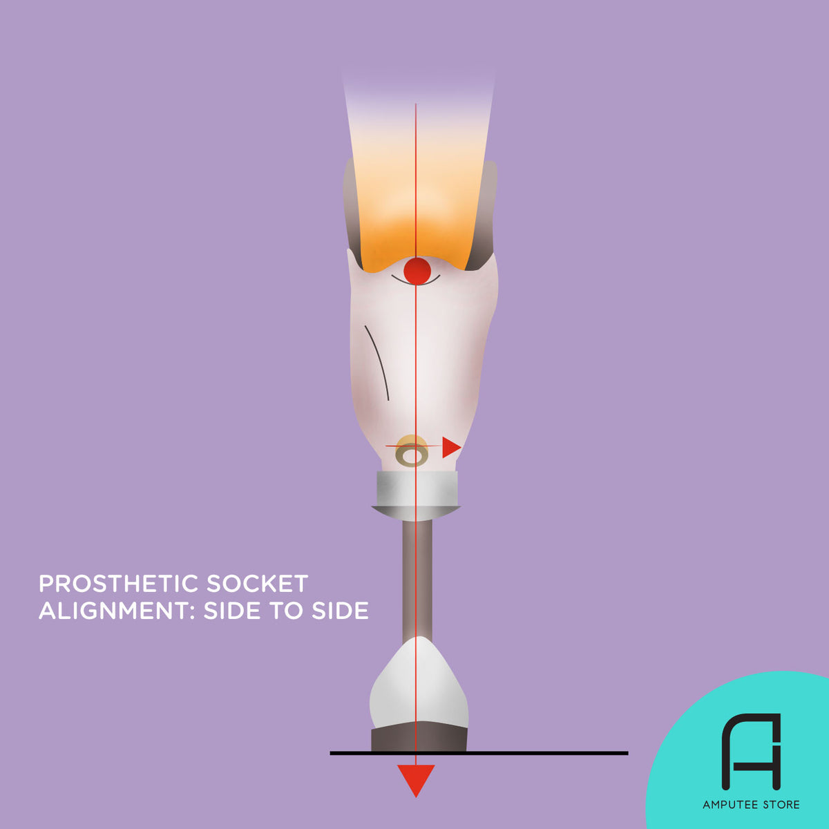 Prosthetic Socket Alignment: Side to Side | Amputee Store