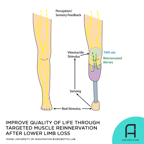 Improve Quality of Life After Lower Limb Loss Through TMR | Amputee Store