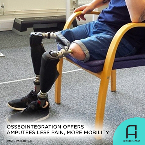 Osseointegration Offers Amputees Less Pain, Mobility | Amputee Store