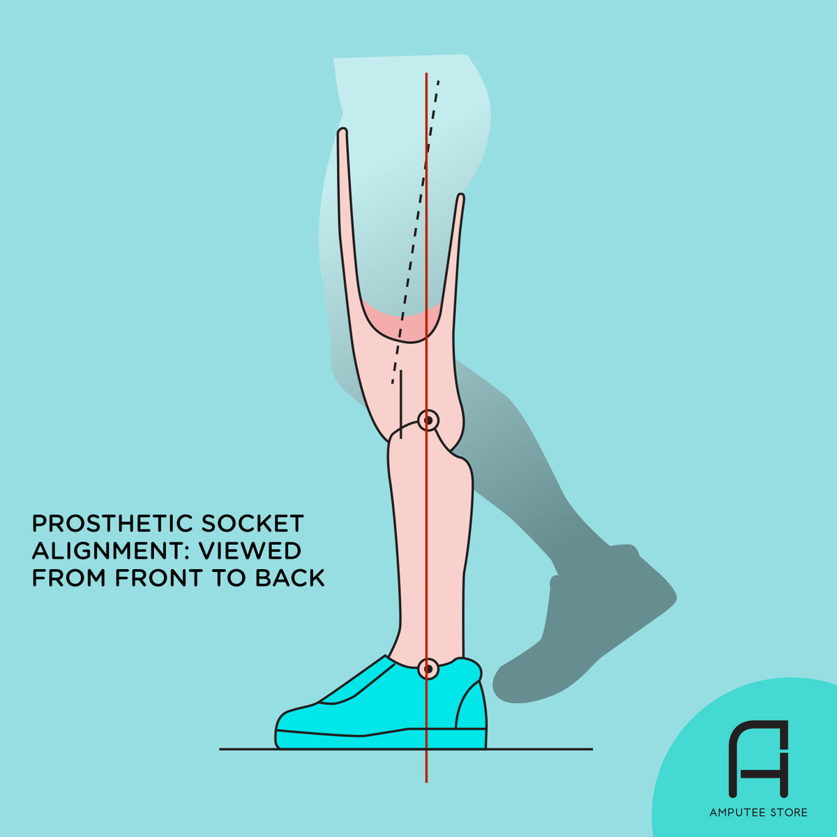 Prosthetic Socket Alignment: Front to Back | Amputee Store